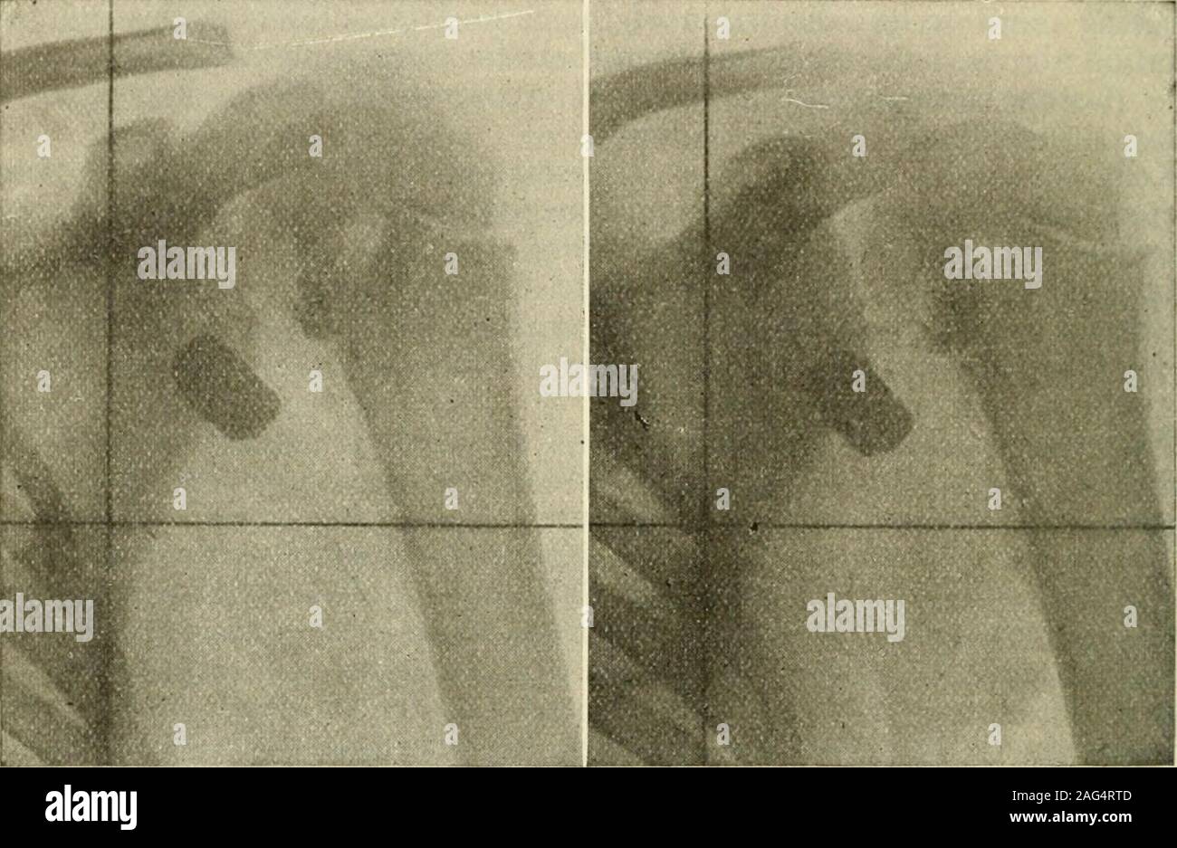 Foreign bodies x rays hi-res stock photography and images - Alamy