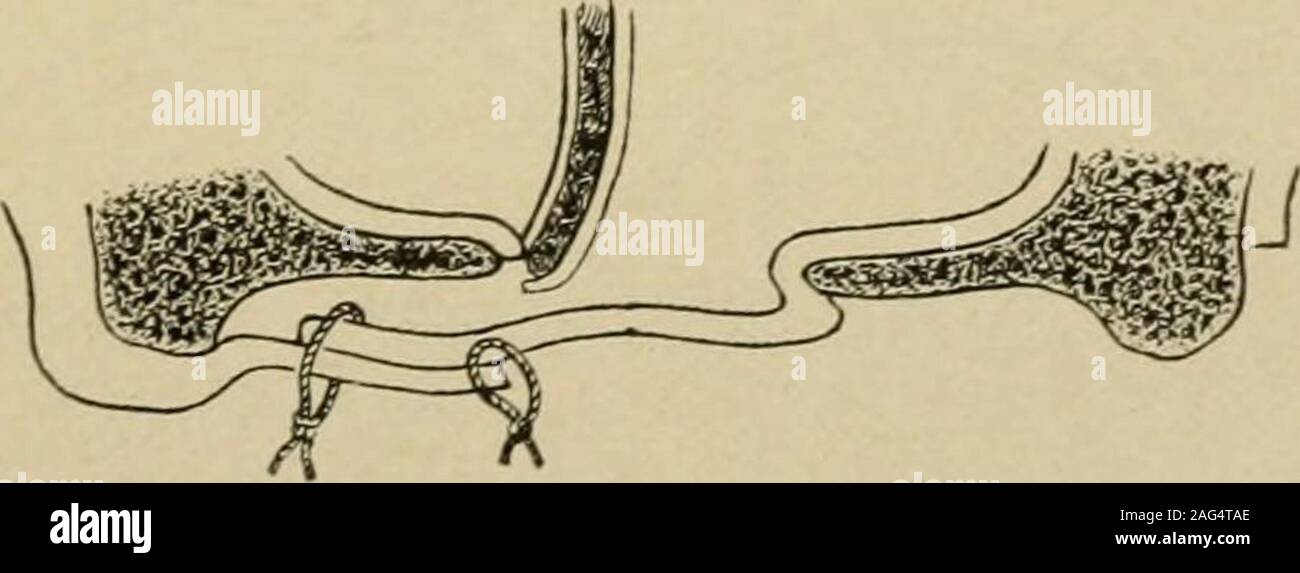 . Manual of operative surgery. Fig. 231.—Lanes uranoplasty.. Fig. 233 ...