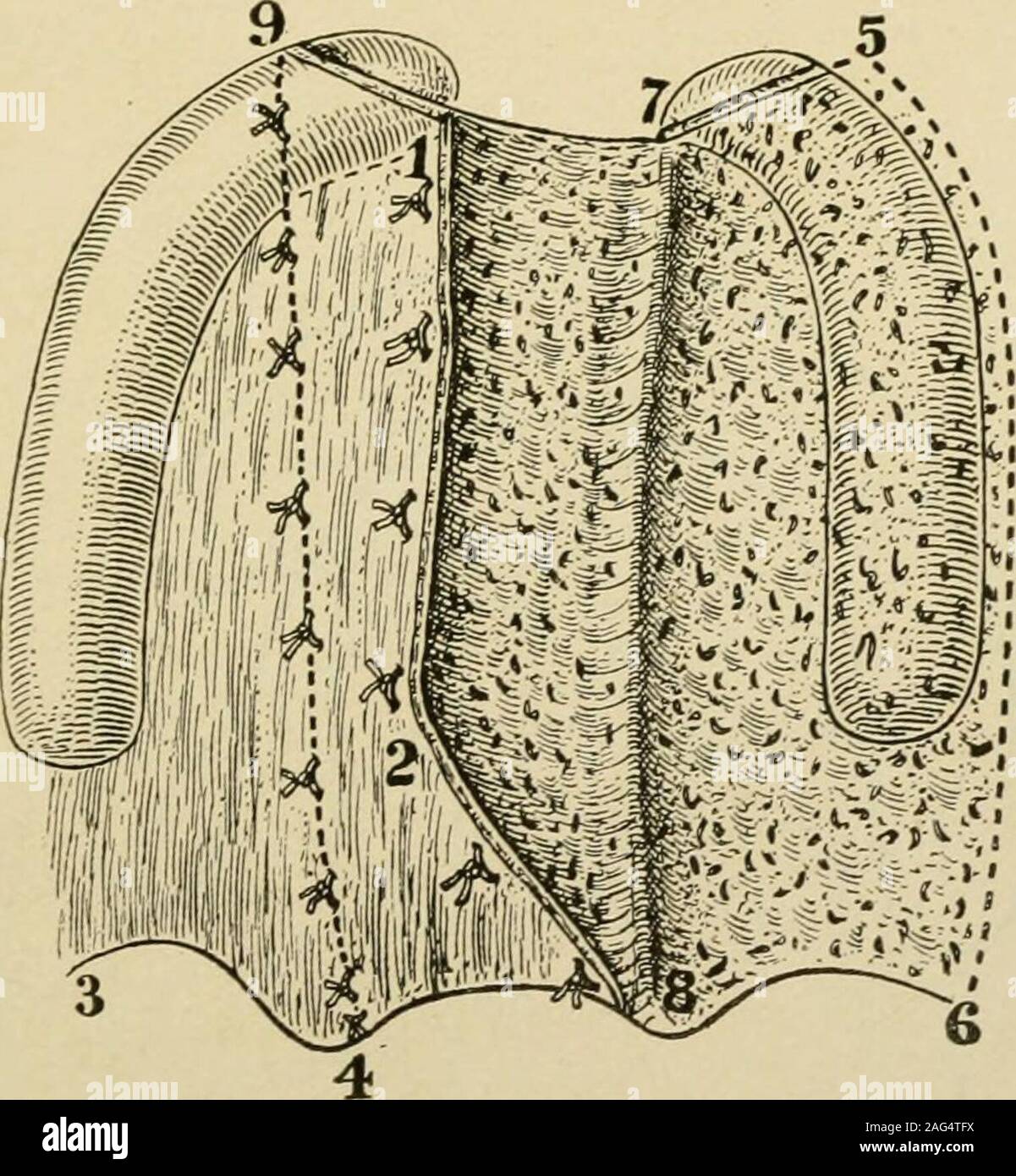 . Manual of operative surgery. Fig. 230.—Lanes uranoplasty.. Fig. 231 ...