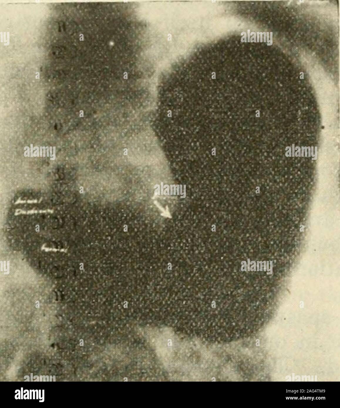 . Modern surgery, general and operative. lcer or to an irritablescar of ...