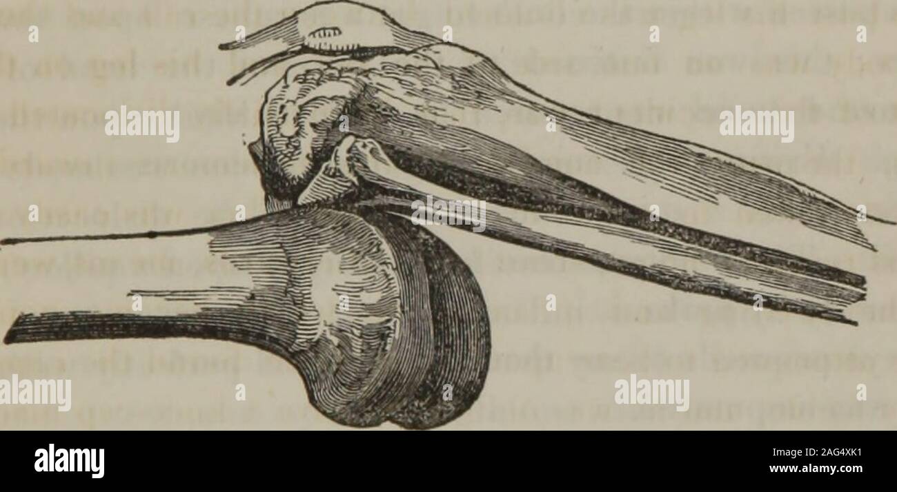 Joint dislocations hi-res stock photography and images - Alamy