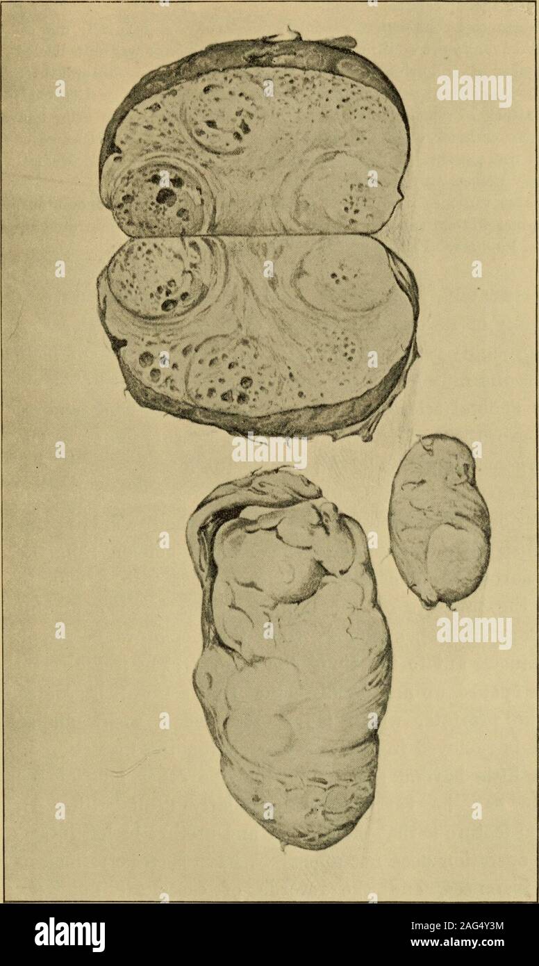 . Clinical lectures on stricture of the urethra and enlargement of the ...