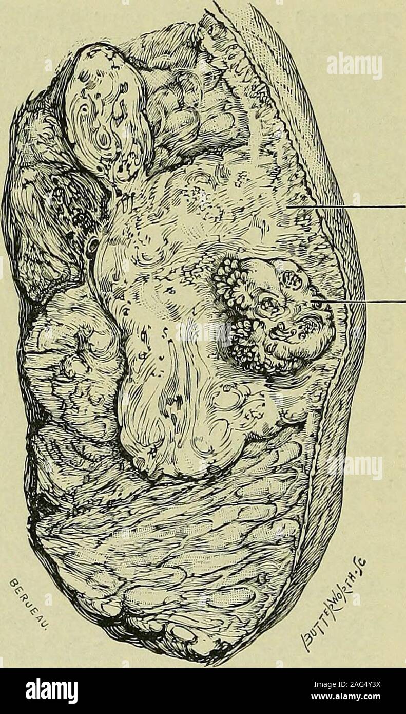 . Tumours, innocent and malignant; their clinical characters and ...