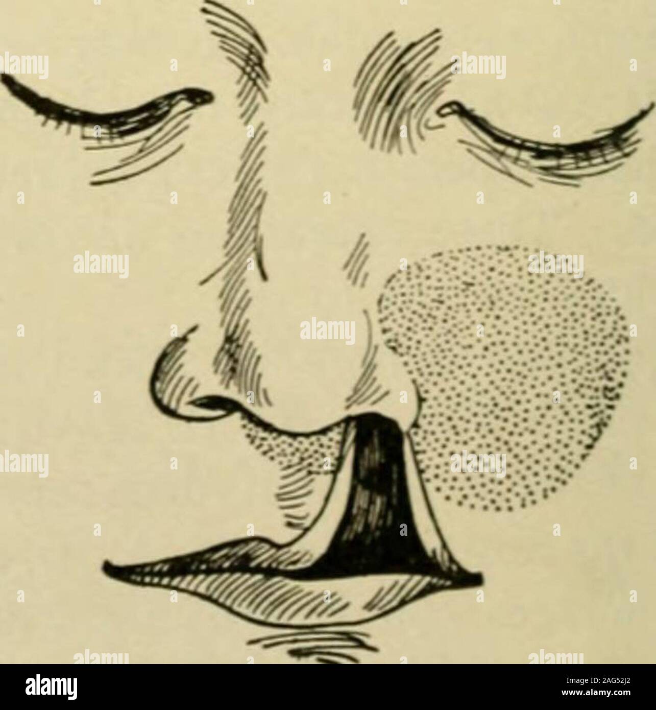 . Manual of operative surgery. Fig. 180.—Relief of tension.. Fig. 190 ...