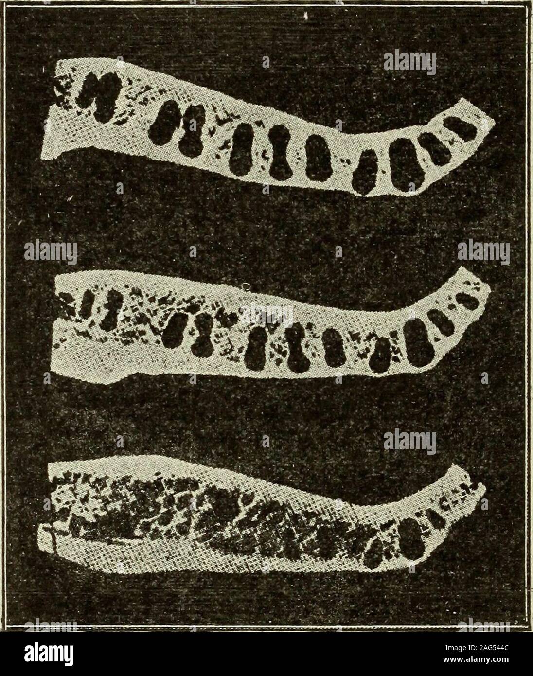 Alveolar process of maxilla hi-res stock photography and images - Alamy