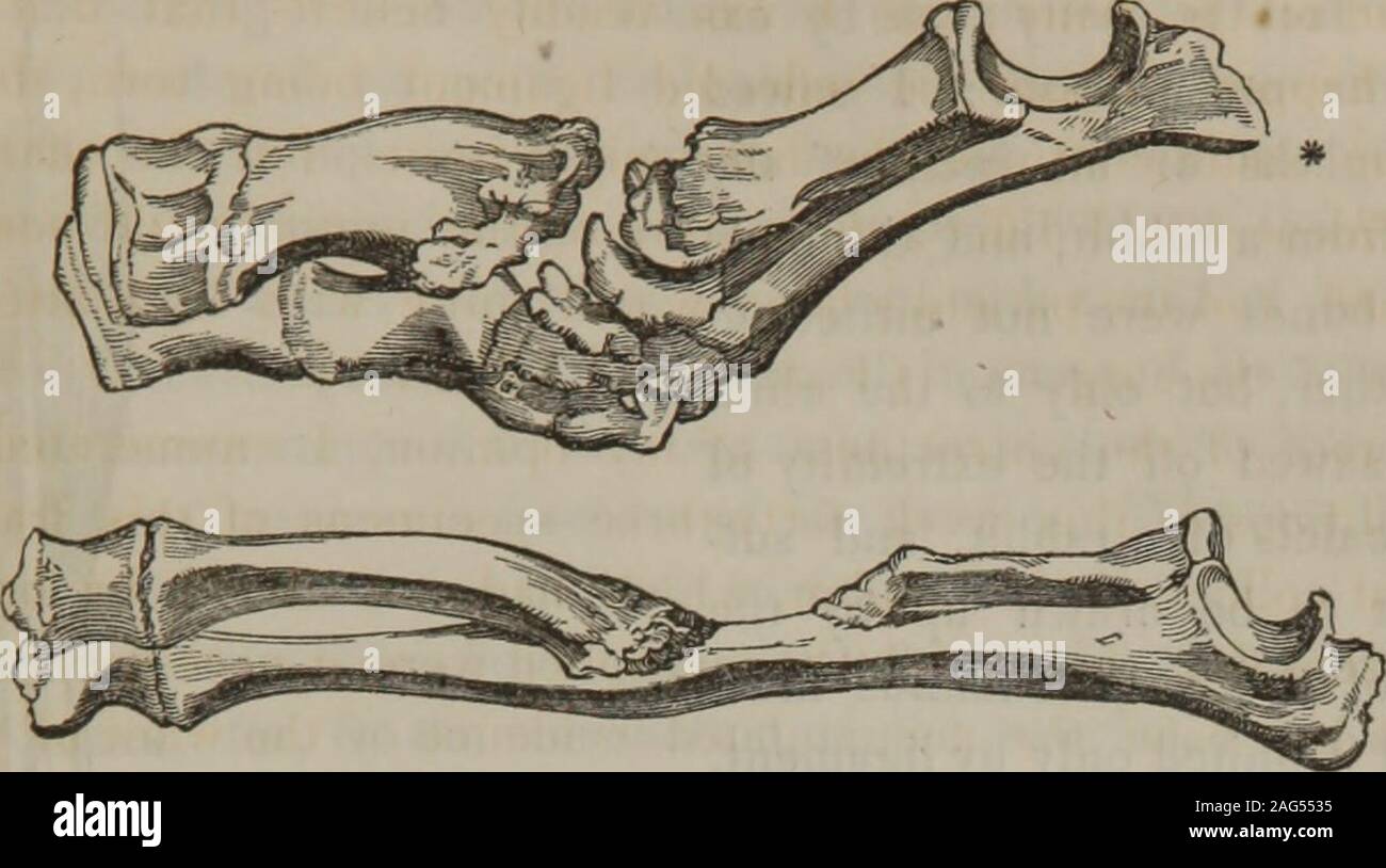 . A treatise on dislocations and fractures of the joints. * This figure ...