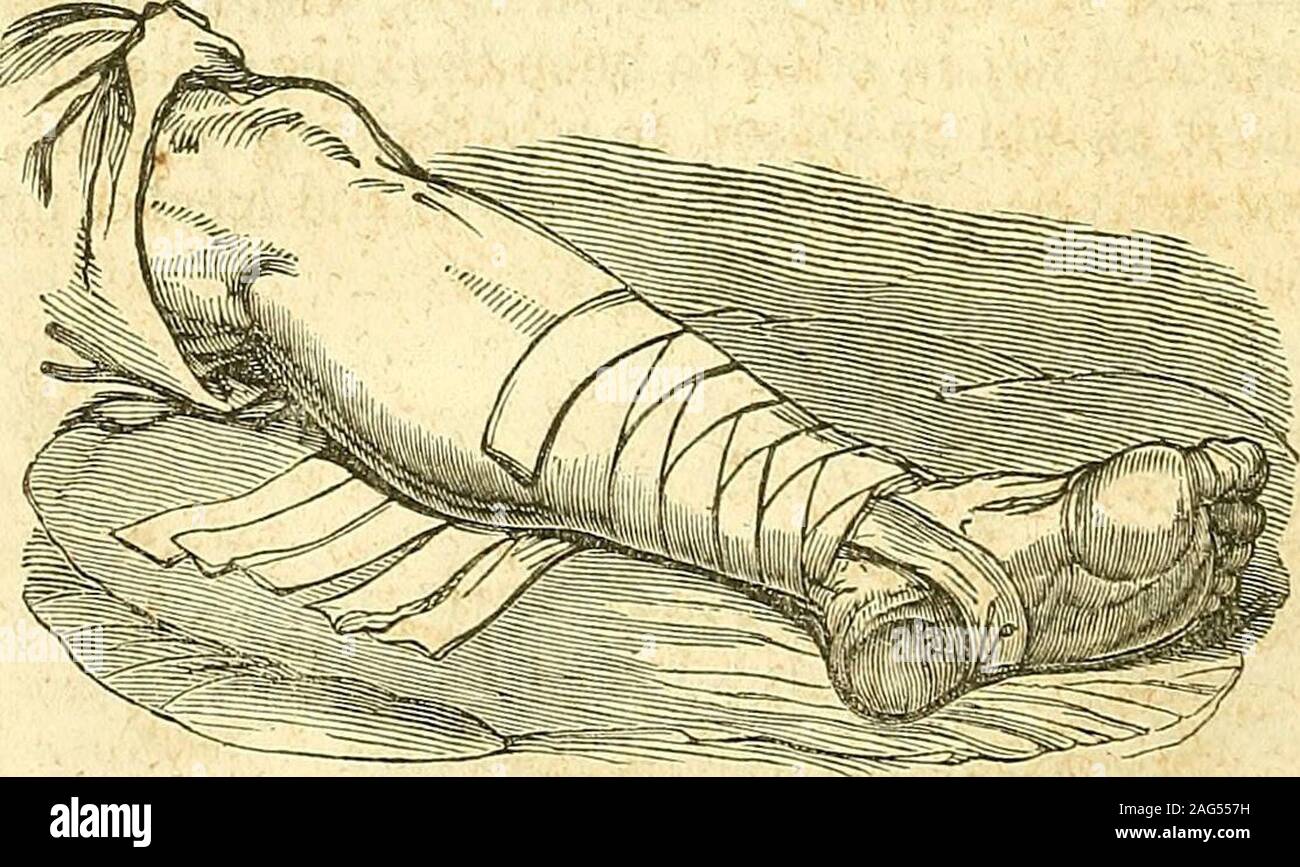 Compound fracture hi-res stock photography and images - Alamy