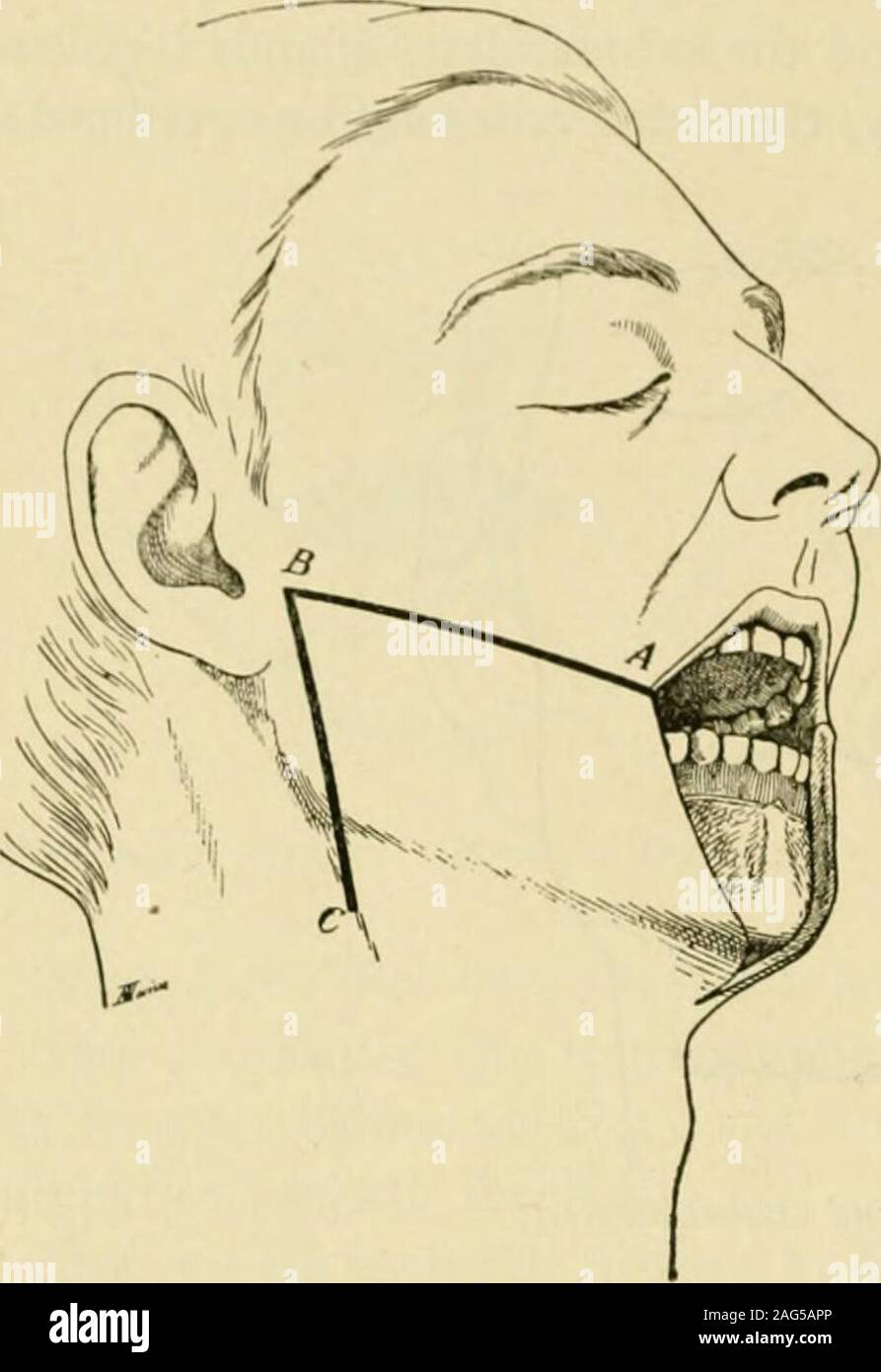 . Manual of operative surgery. Fig. 145.—(Xelaton and Omhredanne.) This ...