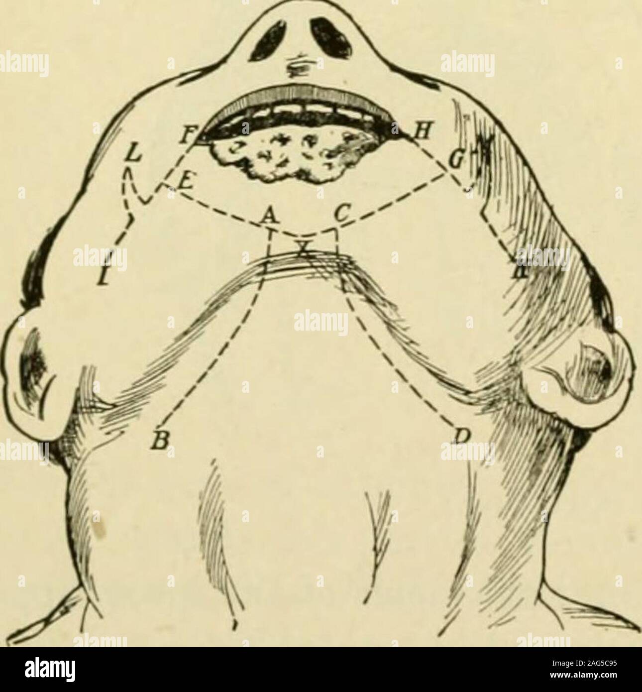 . Manual of operative surgery. 4 to ^ inch distant from the disease ...