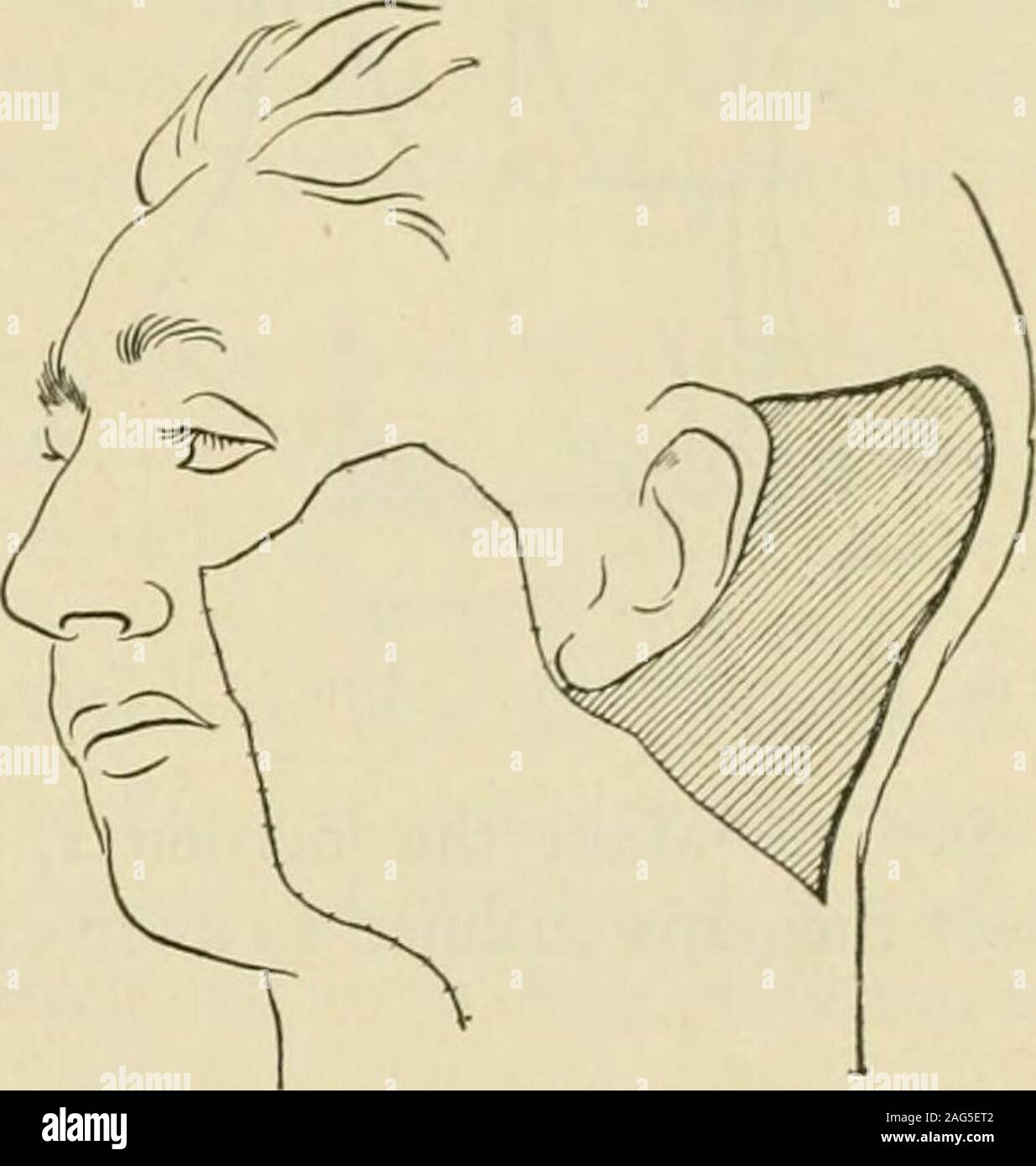 Gillies surgery hi-res stock photography and images - Alamy