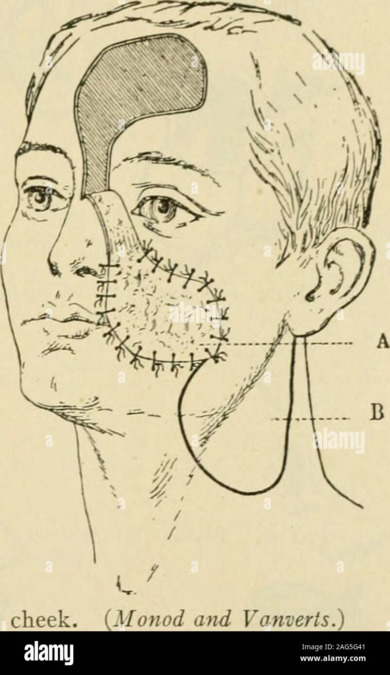 . Manual of operative surgery. Figs. 120 and 121.—Plastic operation on ...