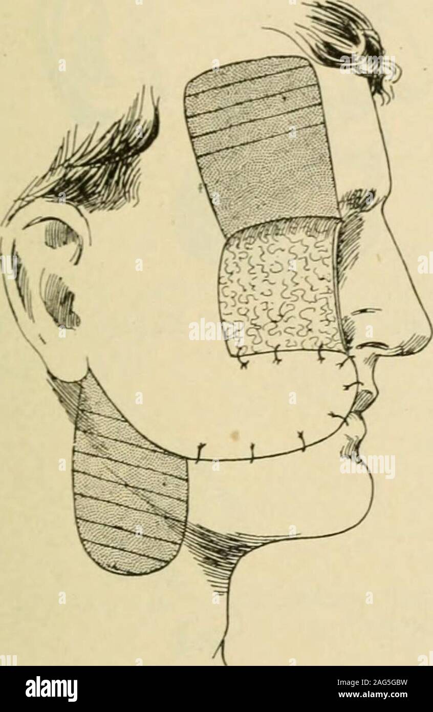 Skin flap repair hi-res stock photography and images - Alamy