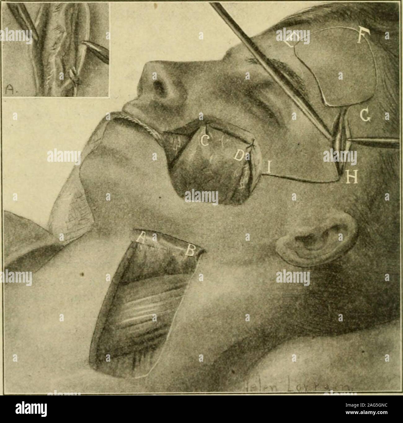 Skin flap repair hi-res stock photography and images - Alamy