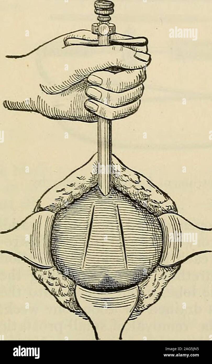 Suprapubic Prostatectomy