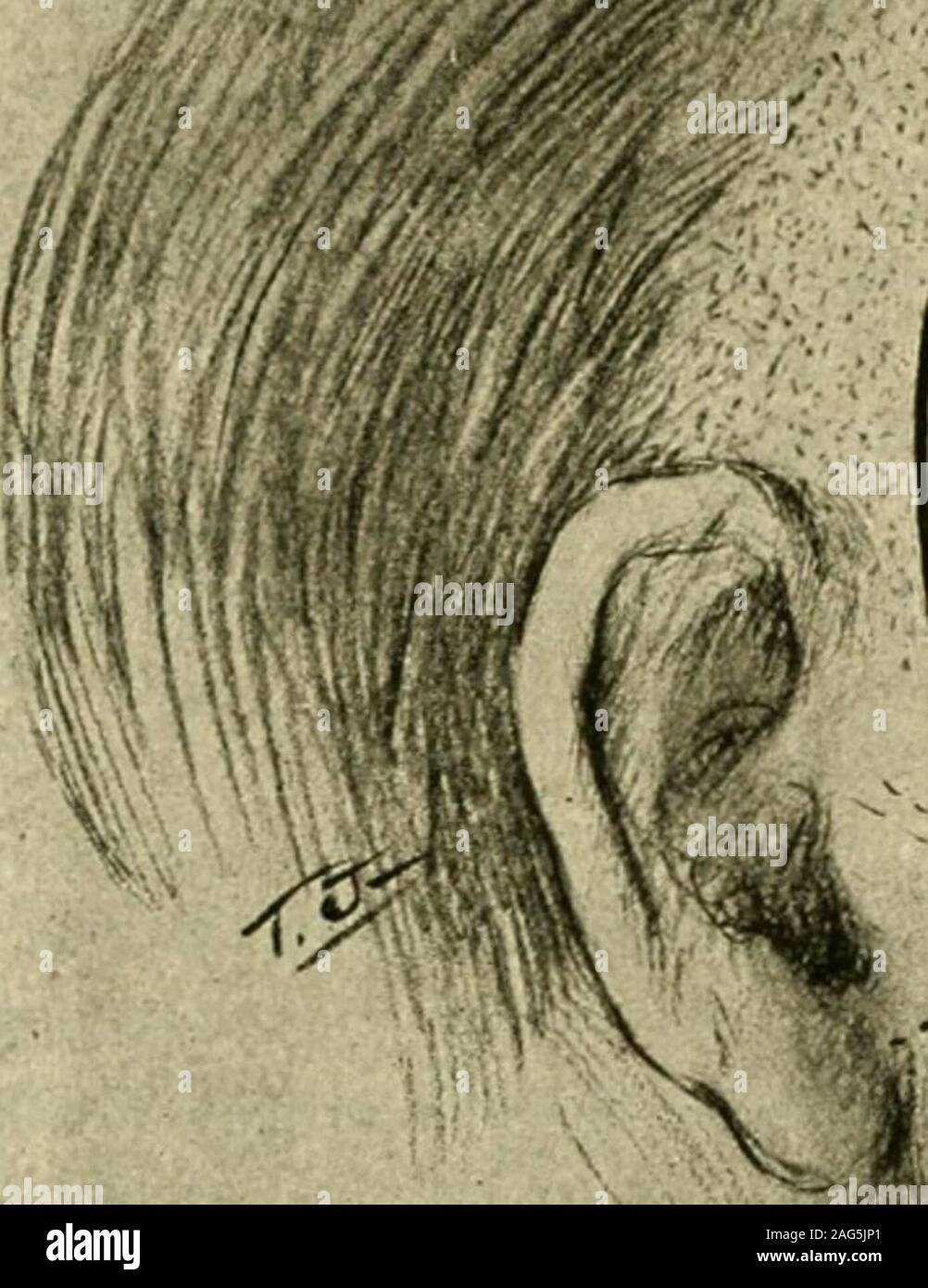 . Manual of operative surgery. If necessary,enlarge the skin-incision ...