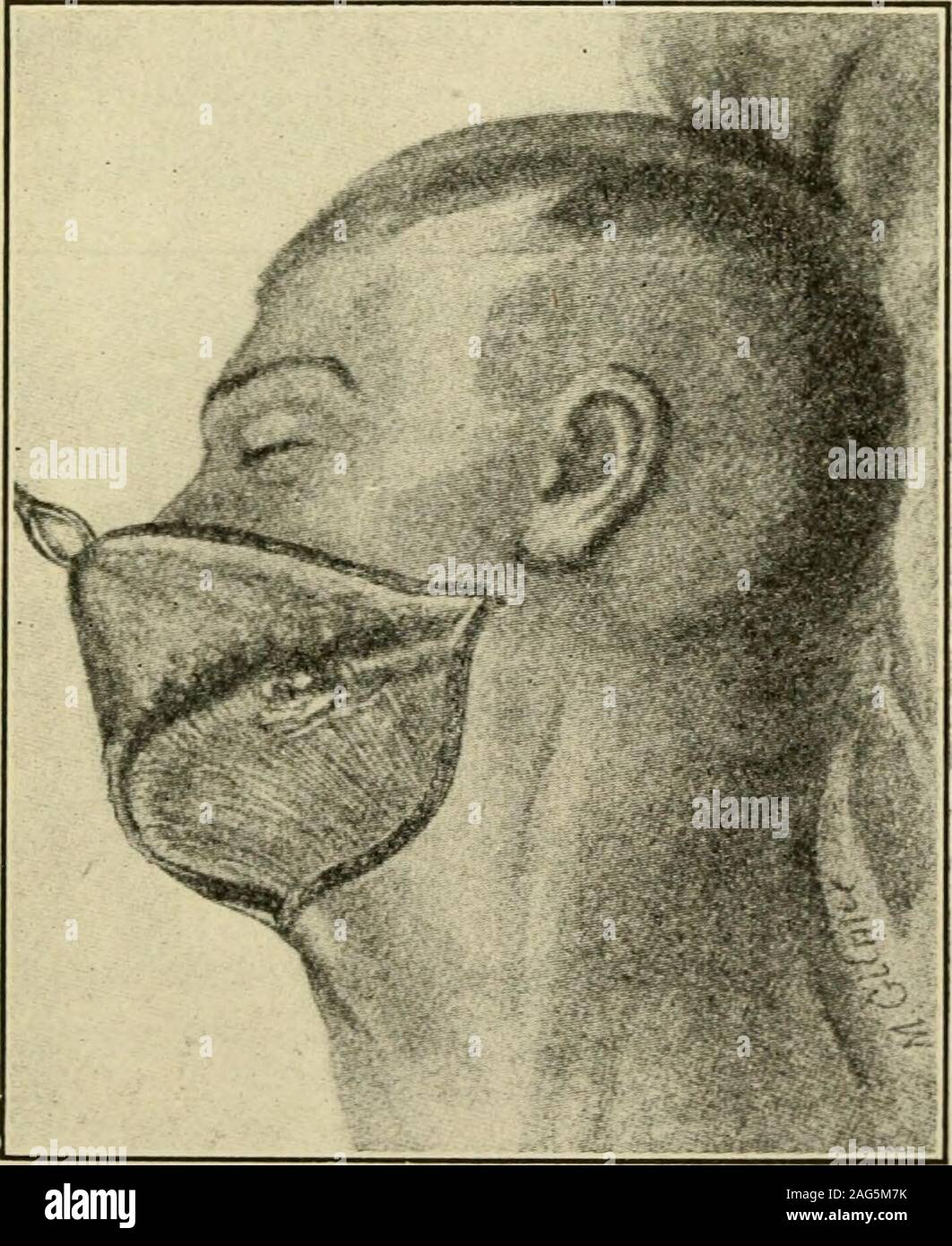 Fractured rib hi-res stock photography and images - Alamy