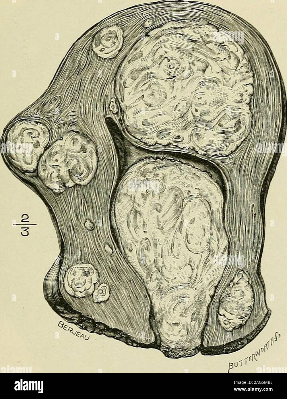 Intramural fibroids hi-res stock photography and images - Alamy
