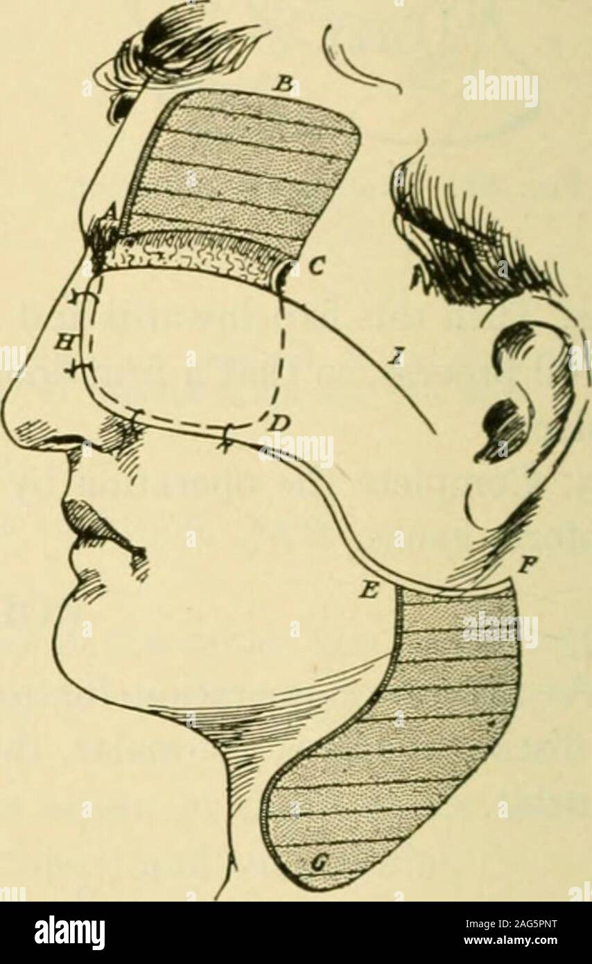 Rodent ulcer hi-res stock photography and images - Alamy
