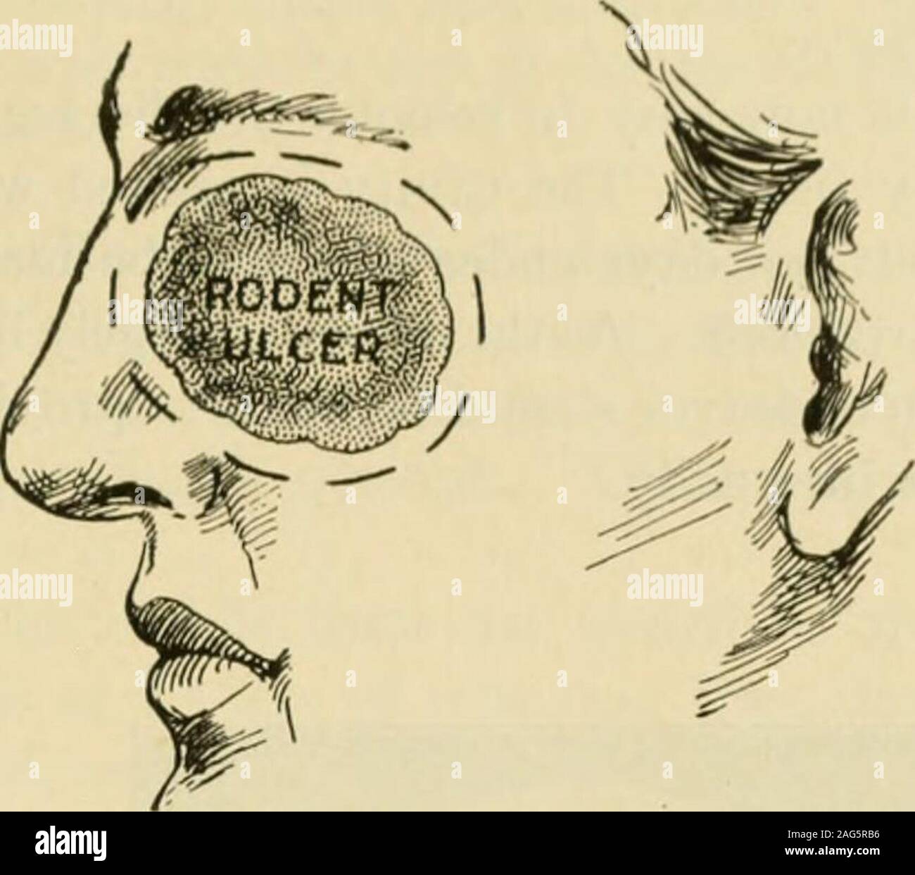 Rodent ulcer hi-res stock photography and images - Alamy