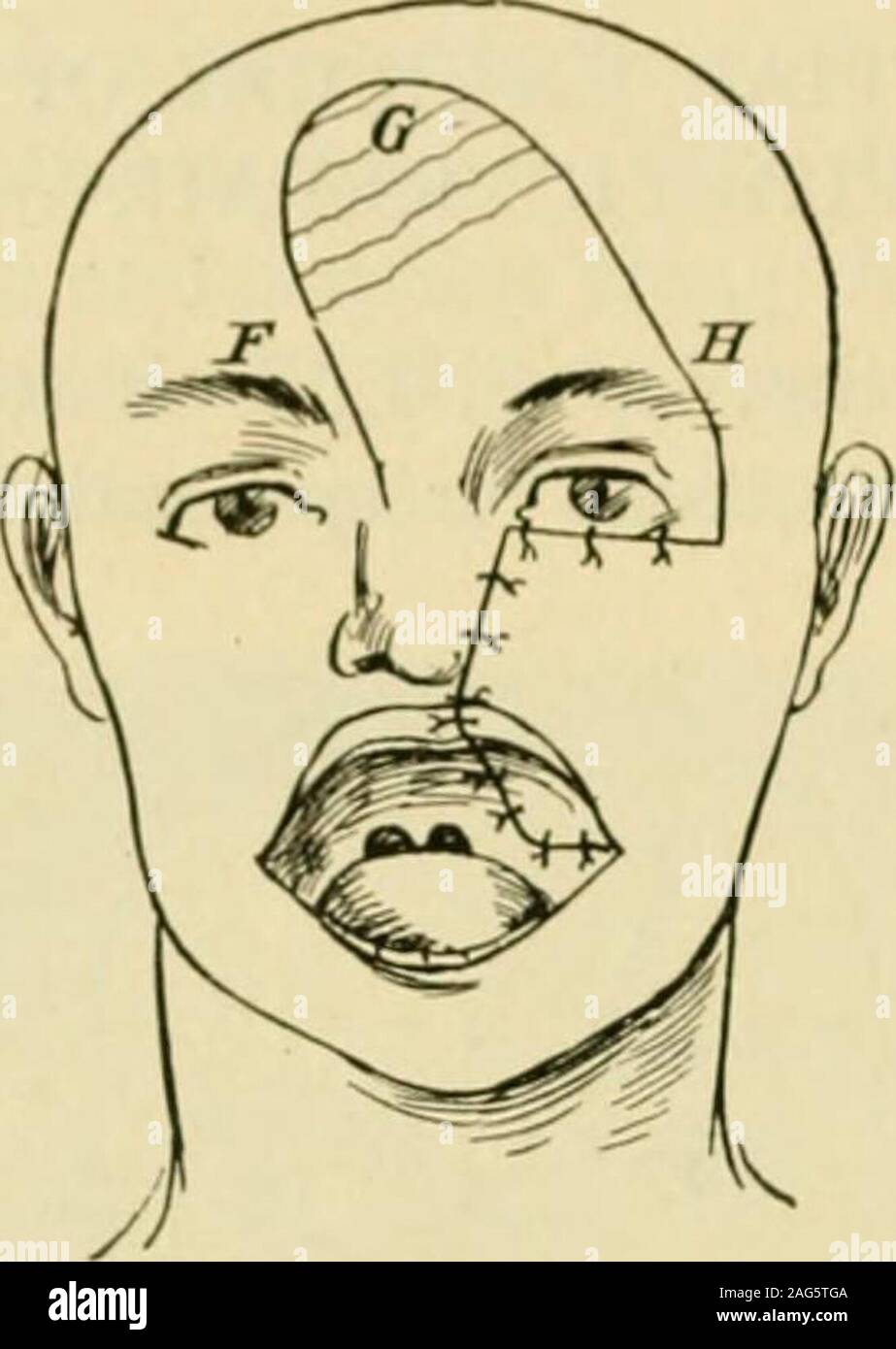 Bone grafts hi-res stock photography and images - Alamy