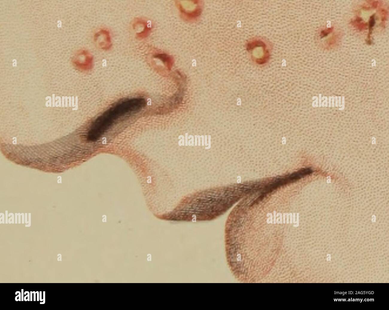 . Description of the distinct, confluent, and inoculated small pox ...