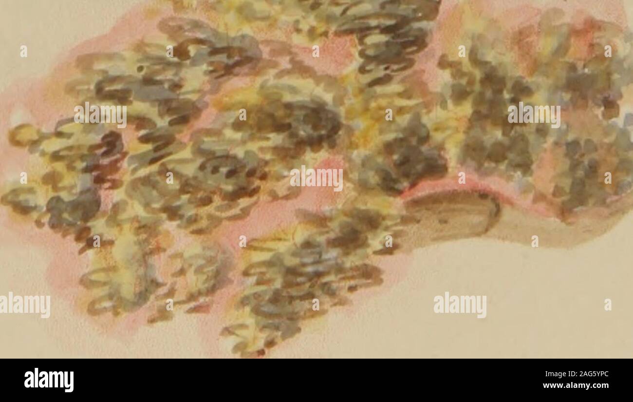 . Description of the distinct, confluent, and inoculated small pox ...