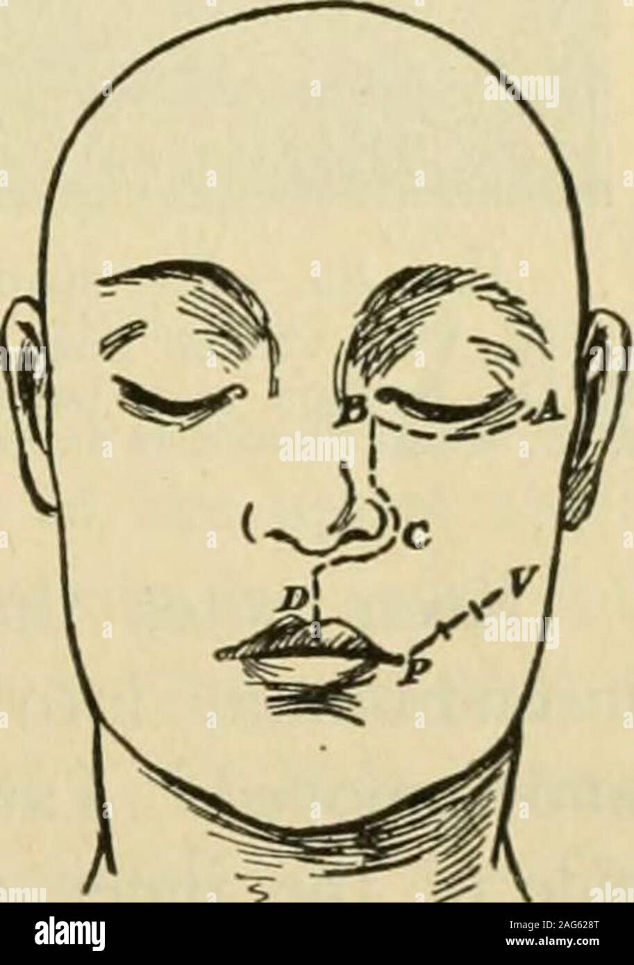 . Manual of operative surgery. ig. 8i). Webers Incision.—Beginning ...