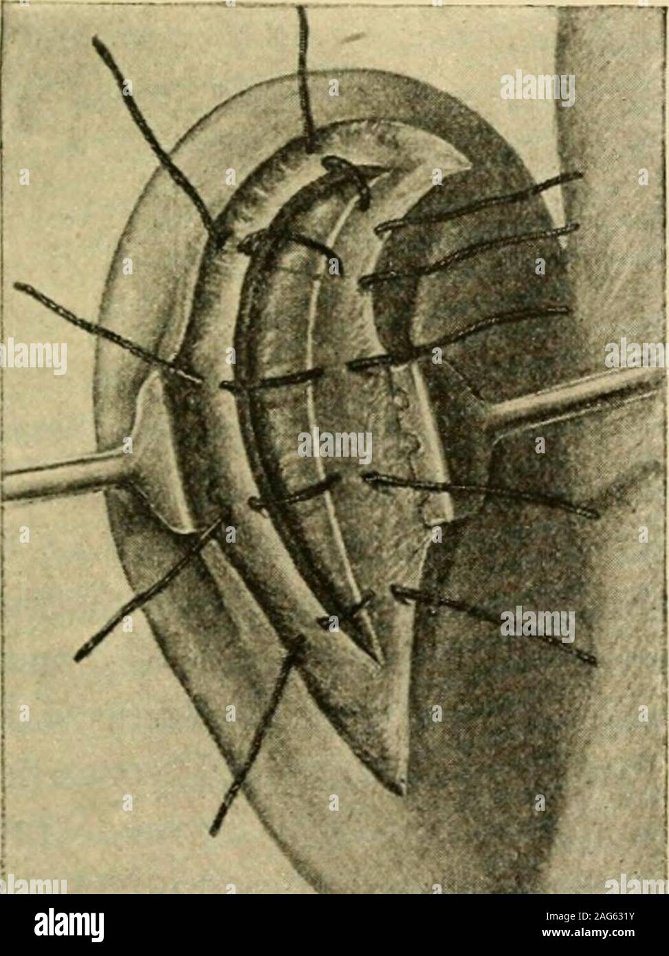. Manual of operative surgery. se the wounds aa, bb, cc with sutures ...