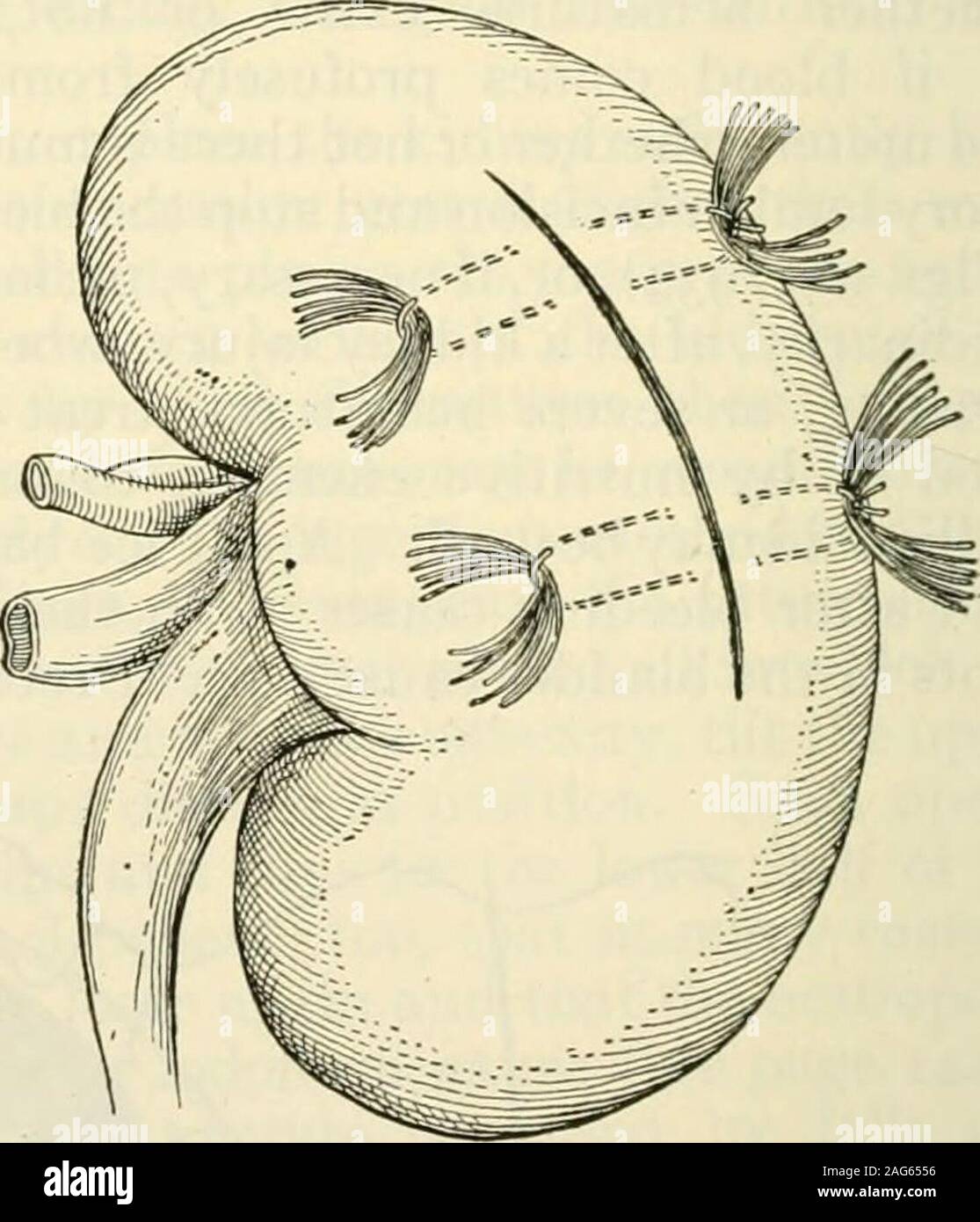 . Modern surgery, general and operative. Fig. 935.—Catgut ring cut into ...