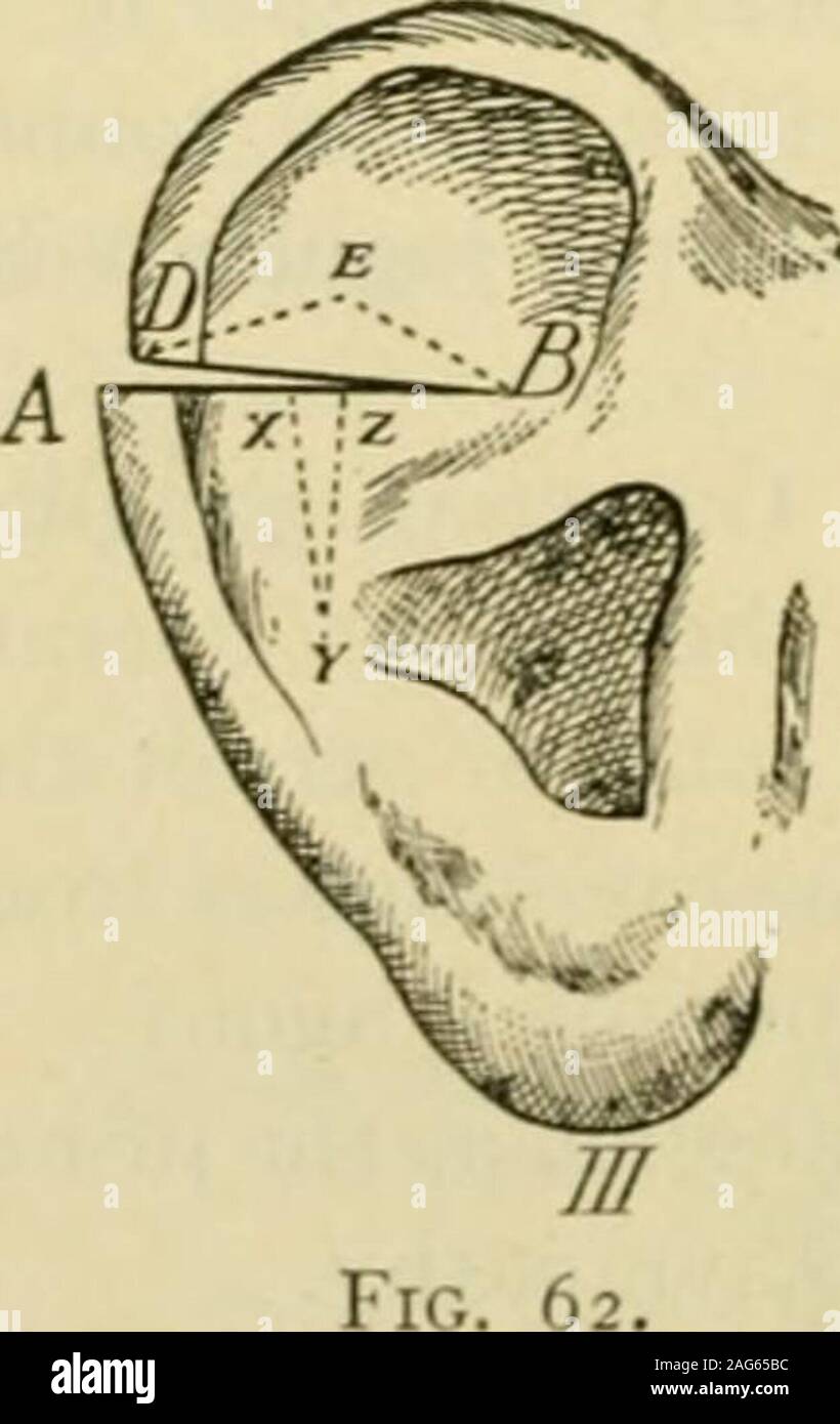 . Manual of operative surgery. ness of the pinna. Pull the upper ...