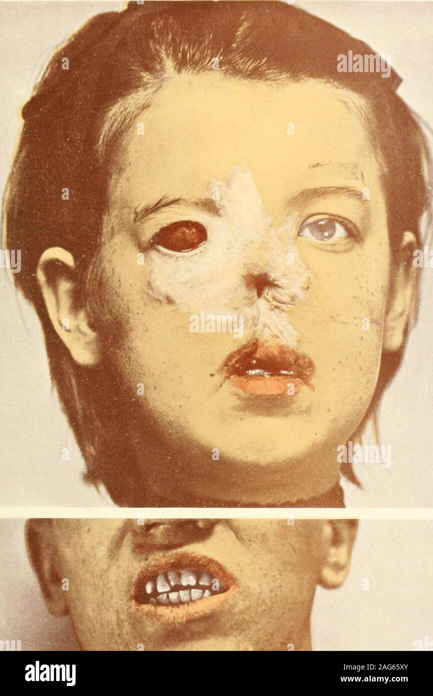 Congenital Syphilis Face