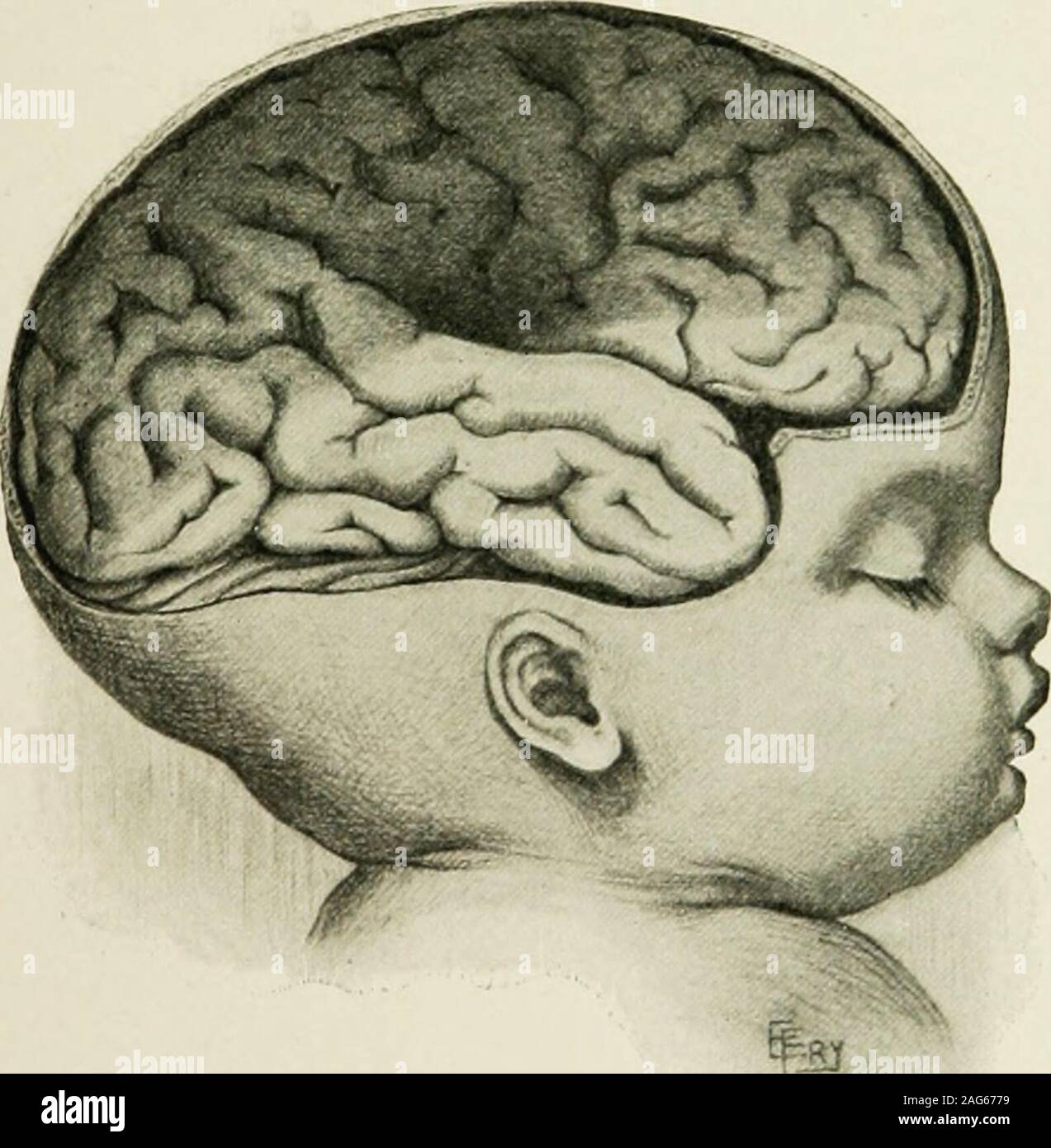Cerebral Palsy Brain Compared To Normal Brain