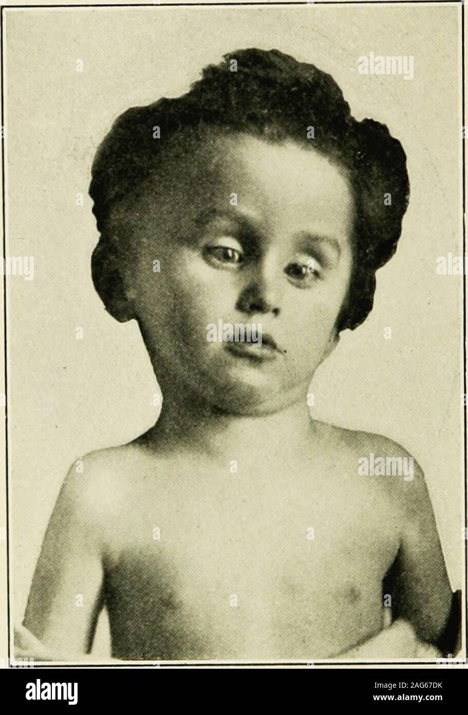 Marasmus hi-res stock photography and images - Alamy