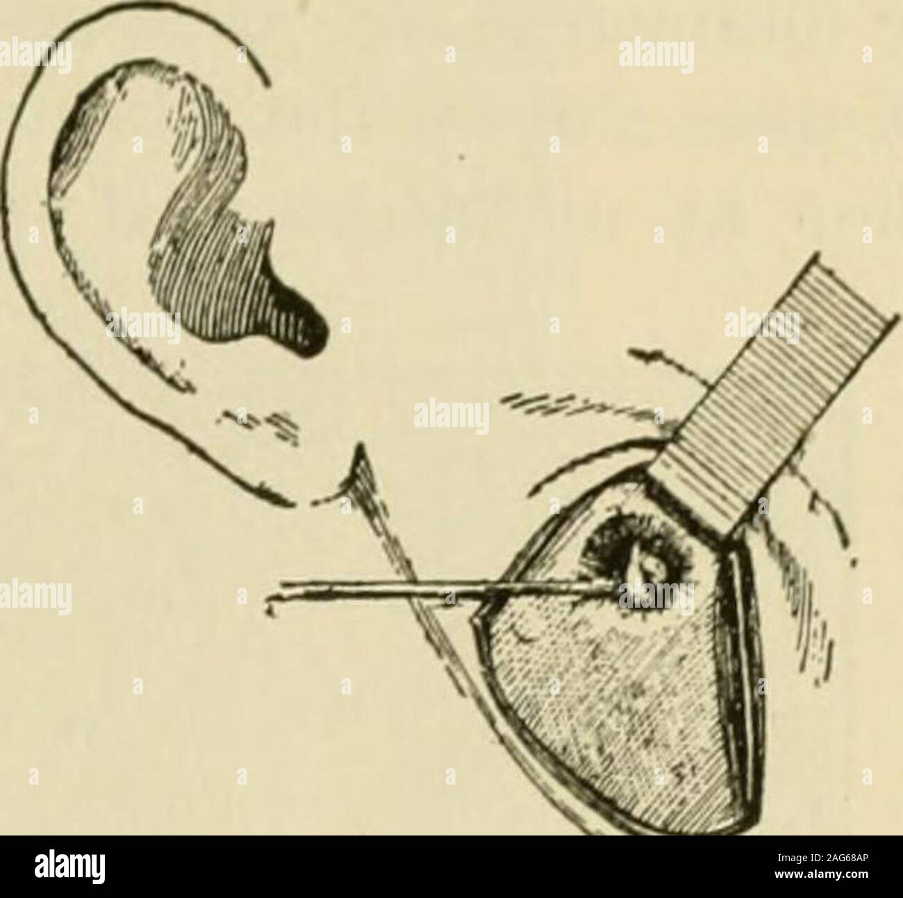 . Manual of operative surgery. ^^. NEURECTOMY TIC 71 inches forwards ...