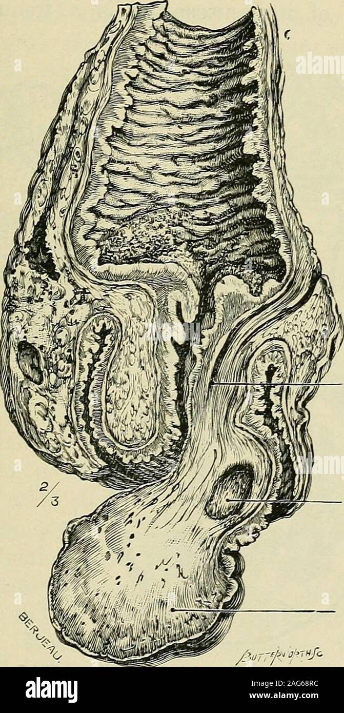 Noma disease hi-res stock photography and images - Alamy