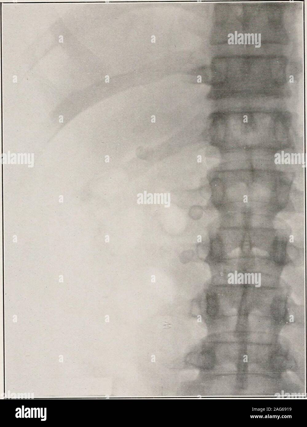 Gallstones In Stool