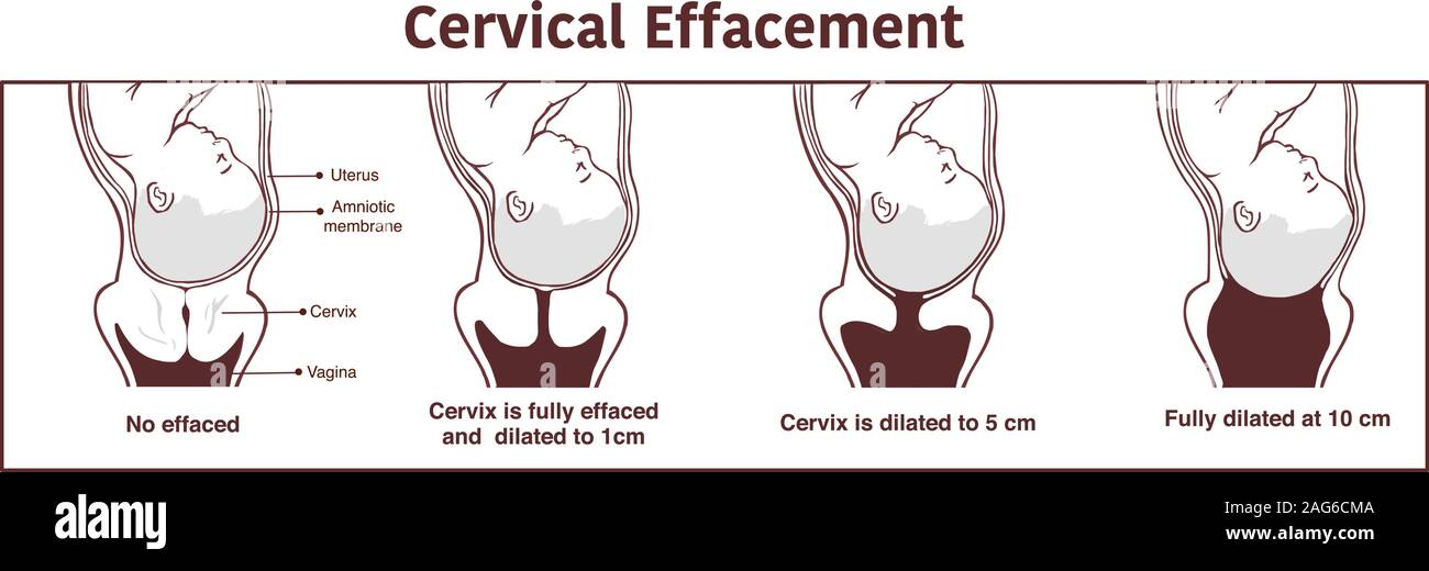 Vector - Cervical effacement and dilatation during labor Stock Vector ...