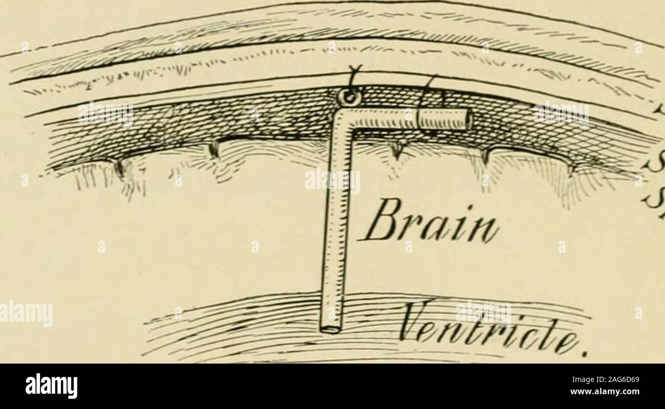 Open brain surgery hi-res stock photography and images - Alamy