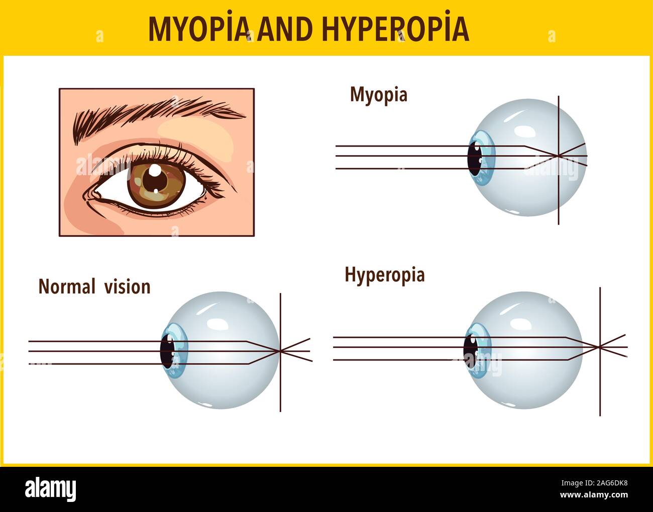 Nearsightedness And Farsightedness Stock Vector Images Alamy