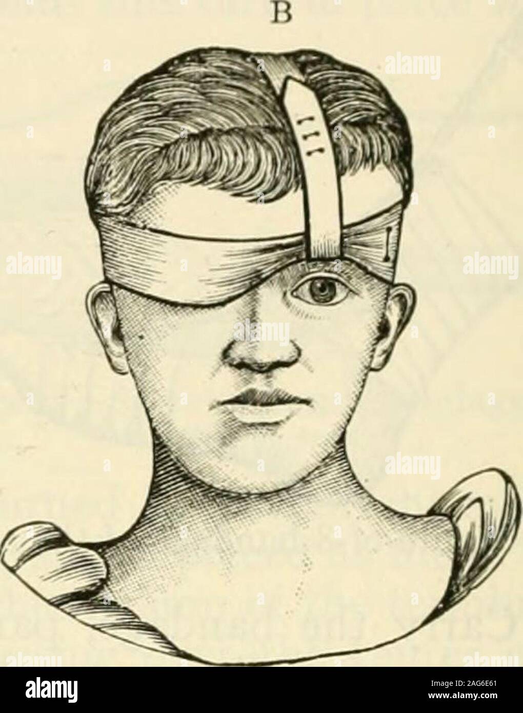 . Modern surgery, general and operative. Fig. 909.—Borschs eye-bandage ...