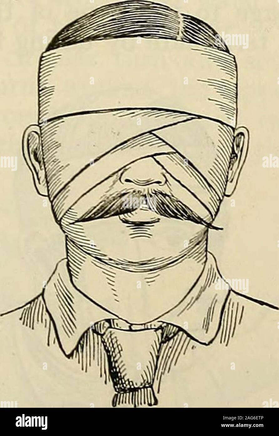 . Modern surgery, general and operative. Fig. 905.—Figure-of-S bandage ...