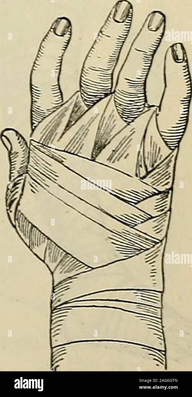 . Modern surgery, general and operative. Fig. 899.—Gauntlet bandage ...