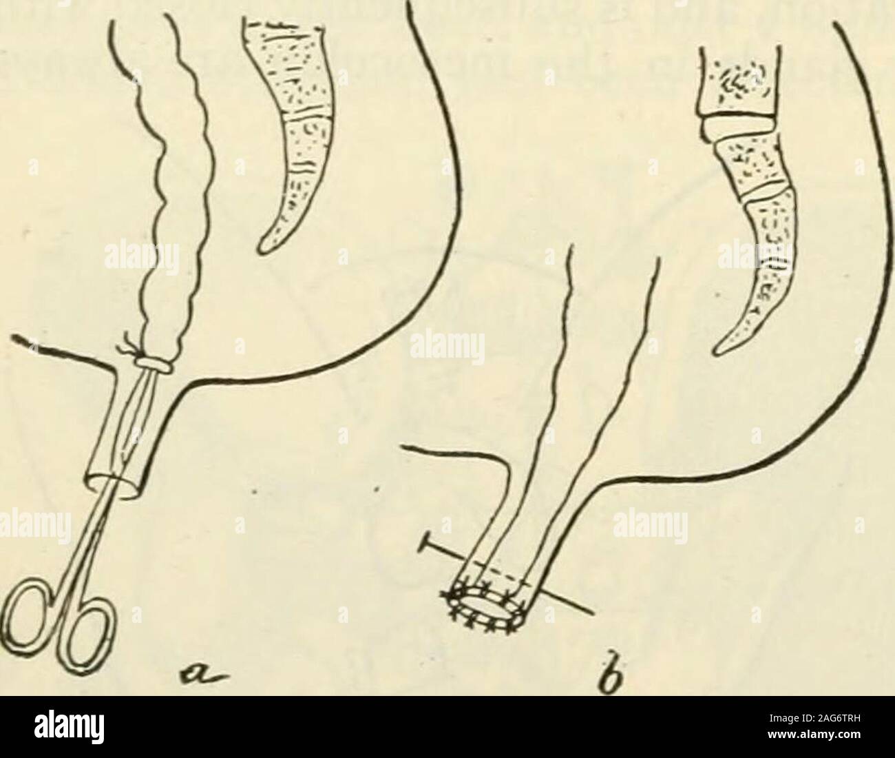 Everted ends hi-res stock photography and images - Alamy