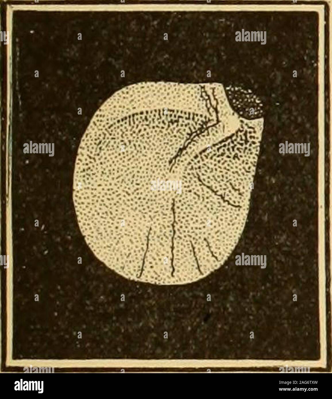 Tympanic membrane perforation hi-res stock photography and images - Alamy