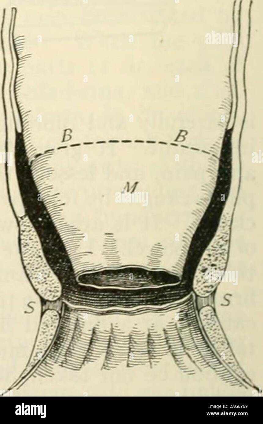 Bowel prolapse hi-res stock photography and images - Alamy