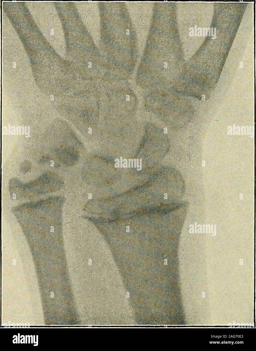 Flexion and extension elbow hi-res stock photography and images - Alamy