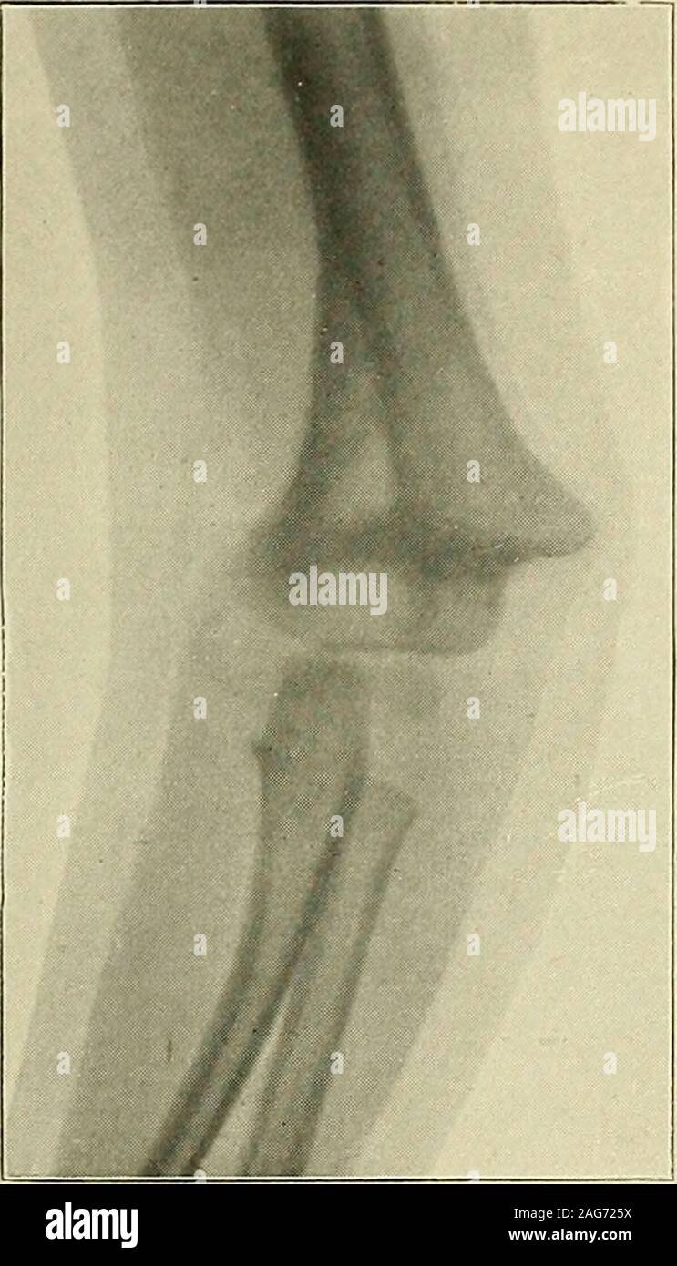 Obvious bone deformity hi-res stock photography and images - Alamy