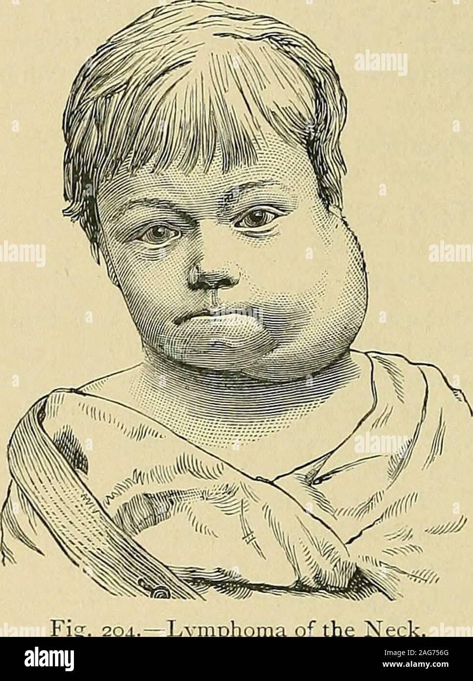 Follicular cyst hi-res stock photography and images - Alamy