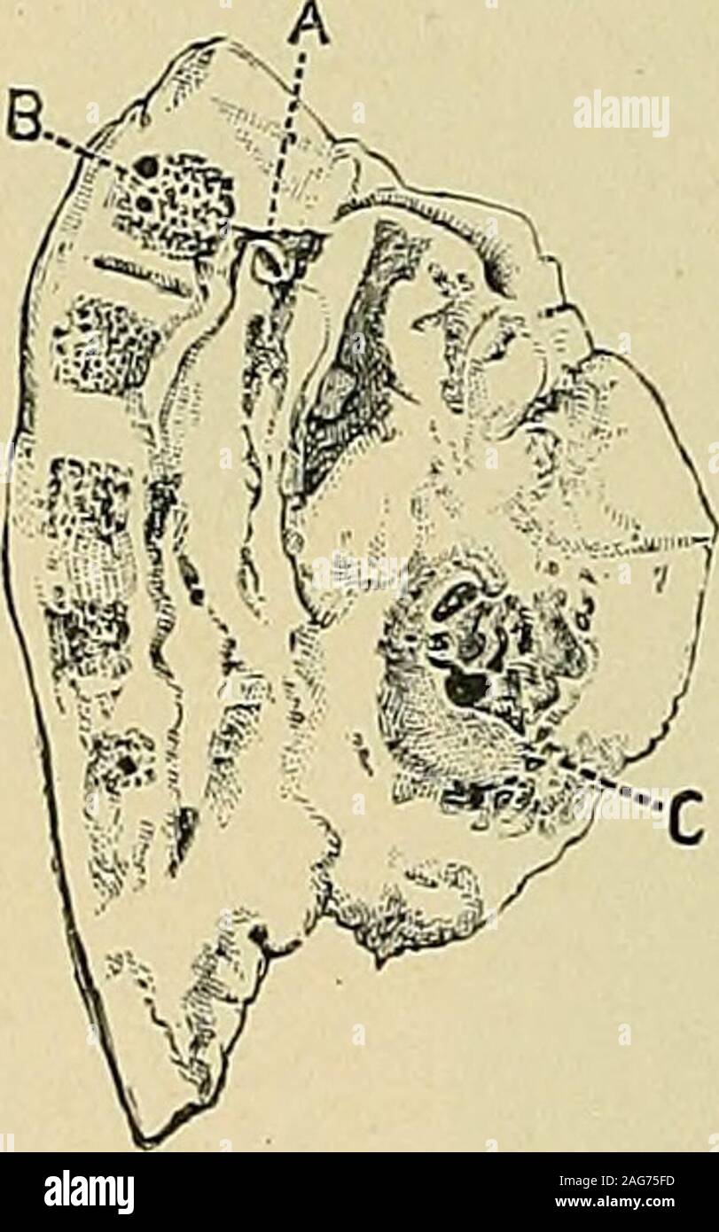 Drainage of cysts hi-res stock photography and images - Alamy