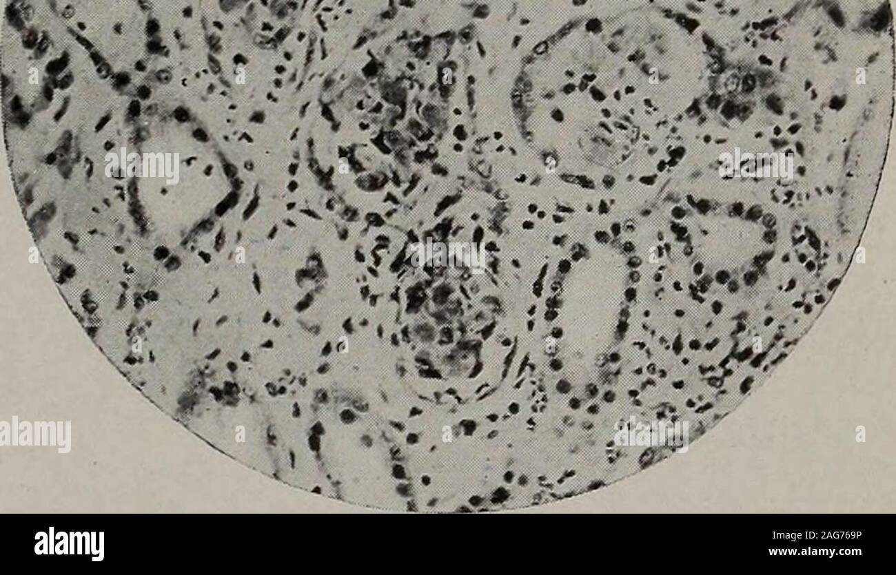 Acute glomerulonephritis hi-res stock photography and images - Alamy